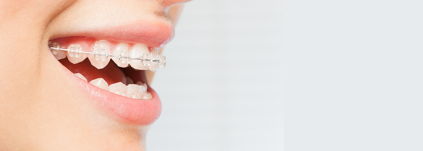 Fixed Clear Braces in West Swindon | Straighten Teeth